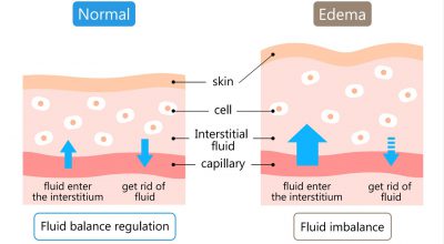 Edema Therapy - The Rane Center StatDVT Services and Edema Therapy
